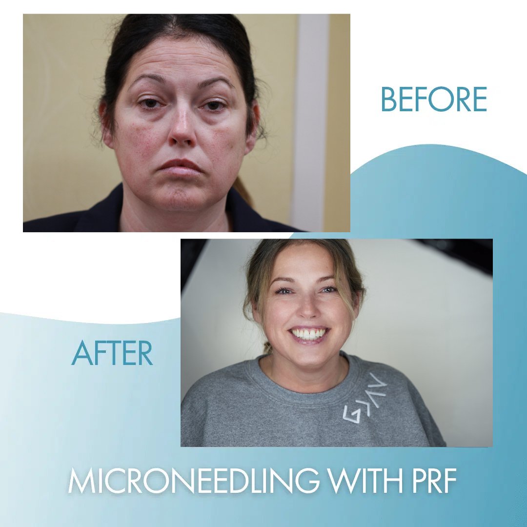 PRF Microneedling Moline IL - Microneedling Quad Cities Area